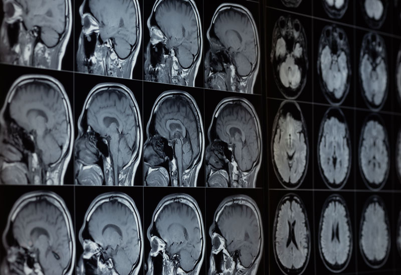 The Menninger Clinic Offering New Rapid Targeted Transcranial Magnetic ...